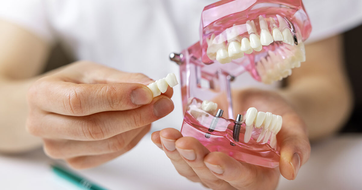 Zahnbrücke: Kosten, Arten, Schmerzen, Haltbarkeit & Risiken | ottonova